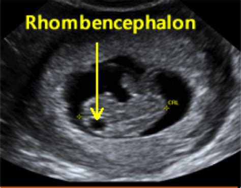 Rhombencephalon Ultrasound