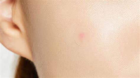 Do Pimple Patches Actually Get Rid Of Acne Reviewed