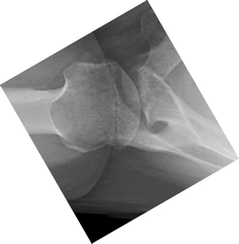 Uw Shoulder And Elbow Academy Glenoid Retroversion ≠ Subluxation Two Year Followup On A Ream