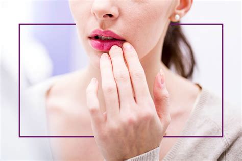 Cold Sores Vs Canker Sores