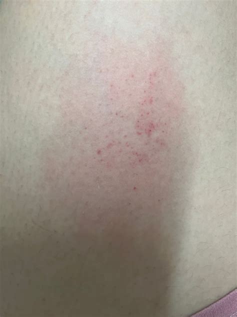 피부 알레르기 인가요 지식in