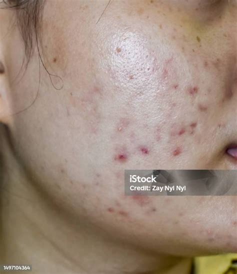 여드름 Vulgaris와 아시아 여성의 얼굴 전체에 흉터 여드름은 모낭이 기름과 죽은 세포로 막힐 때 발생합니다 화이트헤드 블랙헤드 또는 여드름을 유발합니다 여드름에 대한