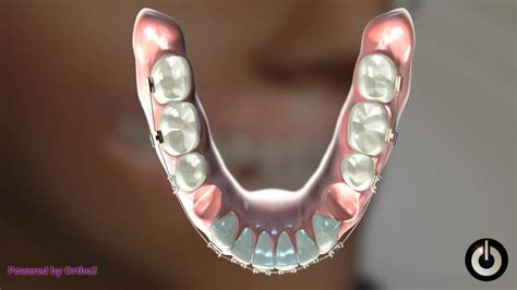 Orthodontic Premolar Extraction At Isabella Embry Blog