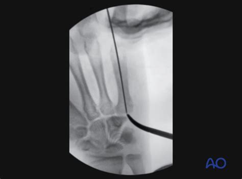 Intramedullary Screw Fixation For Simple Transverse Fracture Of The