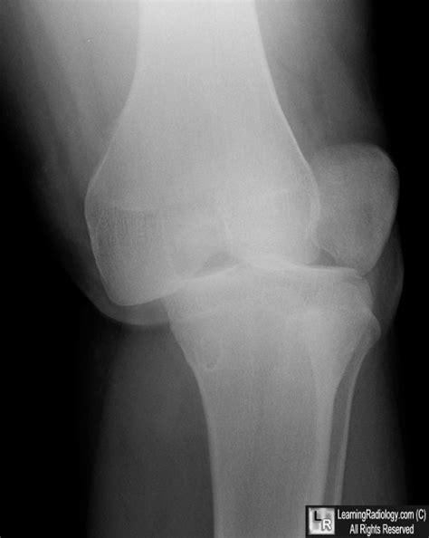 Knee Dislocation Experiences Not Kneecap Knee Joint Dislocations R Kneeinjuries
