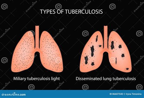 Types Of Tuberculosis Miliary And Disseminated Pulmonary Tuberculosis