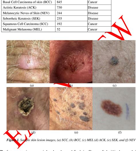 Skin Lesion Classification Using CNN Based Transfer Learning Model Semantic Scholar