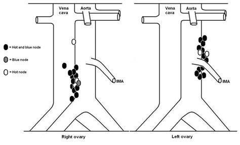Locations Of Sentinel Lymph Nodes After Tracer Injections To The Right Download Scientific