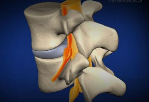 Effective Lumbar Epidural Steroid Injection Procedure