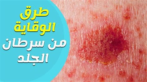 طرق الوقاية والعلاج المنزلي لمرض سرطان الجلد Youtube