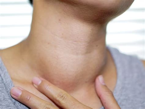 Hyperthyroidism Rash