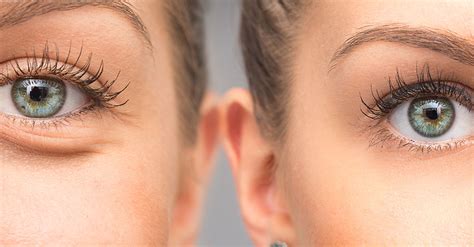 5 Ways To Remove Dark Circles Permanently Sdbotox