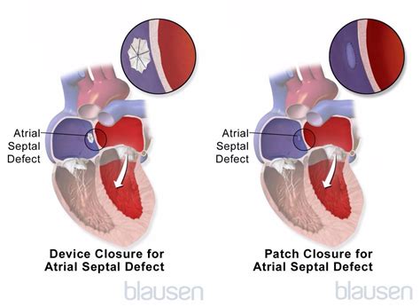 Ventricular Septal Defect