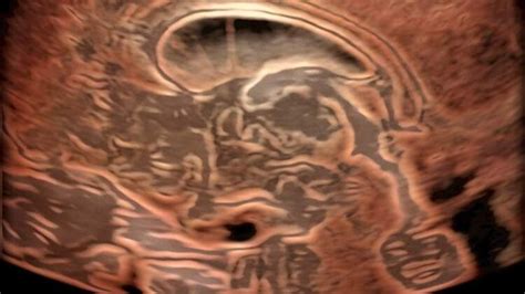 Ge Ultrasound Feature Augment Imaging Reduces Noise Increases