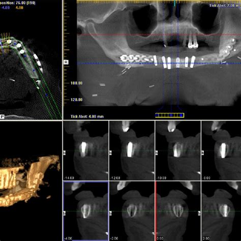 A Cone Beam Radiograph With Three Dimensional Reconstruction Of Male Download Scientific
