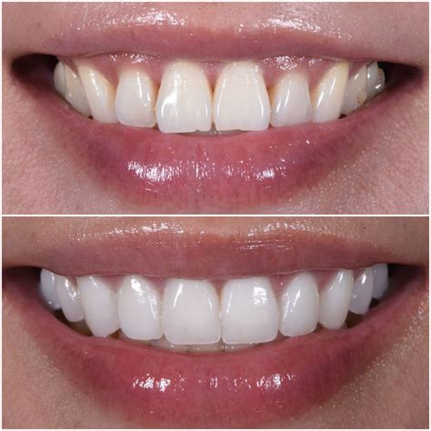 Nyc Porcelain Veneers Upper East Side Cosmetic Dental Veneers