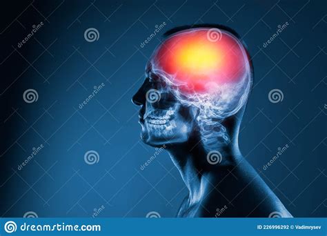 X Ray Of A Man S Head Cerebral Stroke Brain Damage Is Highlighted By