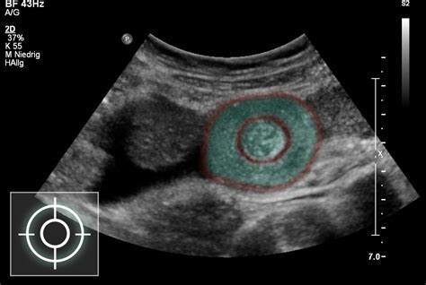 Imaging In Intussusception Sinaiem