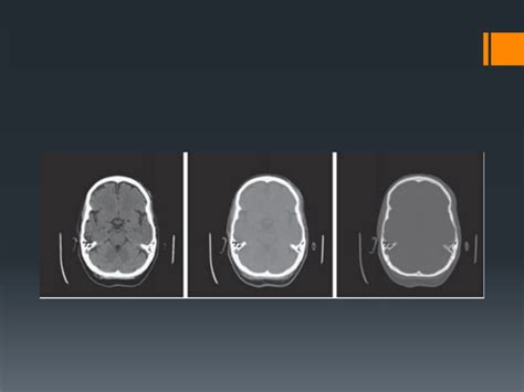 Brain Ct Interpretation Pdf Brain And Nervous System Disorders Diseases And Conditions