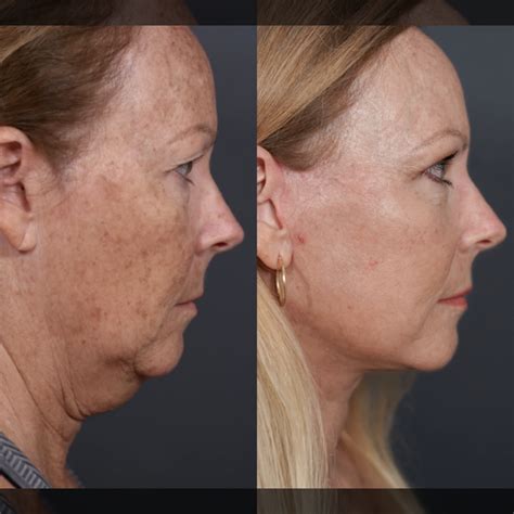 Bbl Broadband Light Before And After Photos Nassifmd® Medical Spa
