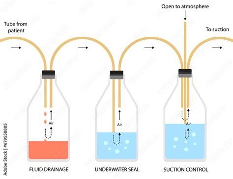 Tube Thoracostomy Procedure At Mary Kemp Blog