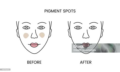 안료 반점 시술 전과 벡터에 치료 라인 아이콘을 적용한 후의 레이저 미용 매끄럽고 깨끗한 피부와 문제성 피부를 가진 여성의 삽화