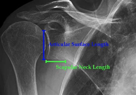 Figure 1 From Relationship Of Scapular Neck Length To Scapular Notching After Reverse Total