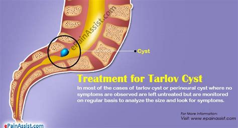 Tarlov Cyst Treatment Non Surgical And Surgical Treatment
