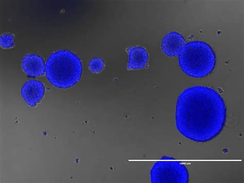 Glioma Diffuse Intrinsic Pontine Glioma Dipg