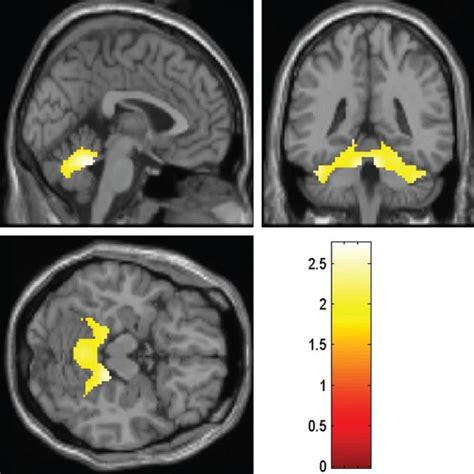 Significant Negative Correlation Between Cerebellar Gray Matter Volume Download Scientific