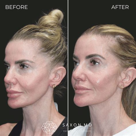 Brow Bone Reduction For Women With Frontal Bossing