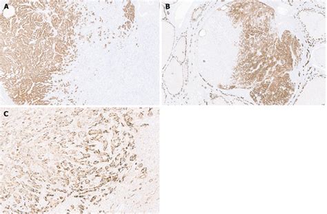 Combined Hepatocellular Cholangiocarcinoma A Clinicopathological