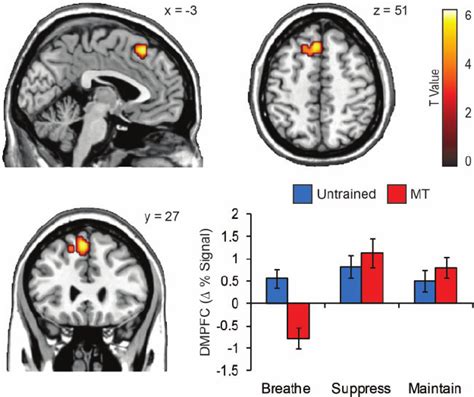 Dorsomedial Prefrontal Cortex