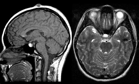 Pituitary Cyst Mri