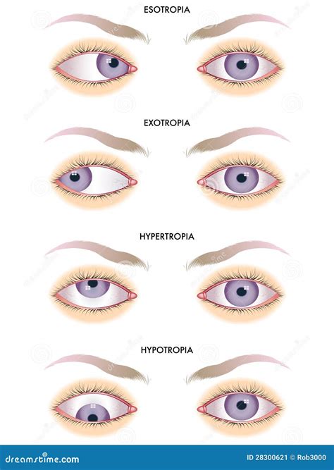 Strabismus Cartoons Illustrations And Vector Stock Images 277 Pictures To Download From