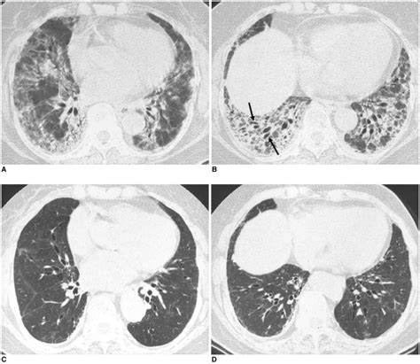 Non Specific Interstitial Pneumonia In A 73 Year Old Woman A B Lung Download Scientific