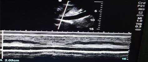 Inferior Vena Cava Collapsibility Index For The Assessment O Journal Of Marine Medical Society