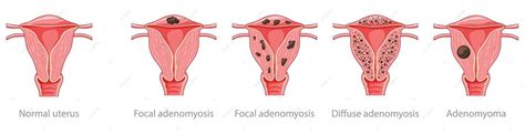 Human Female Reproductive System Icons Adenomyosis Focal Diffuse Adenomyoma And Normal Uterus