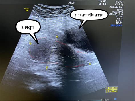 2 ปีที่แล้วคนไข้ของผมมีเนื้องอก อรัณ ไตรตานนท์ โต๊ะทำงาน