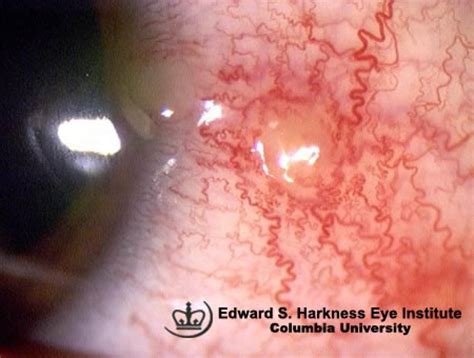 Phlyctenular Keratoconjunctivitis Vagelos College Of Physicians And Surgeons