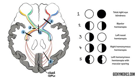 Visual Field Defect Map