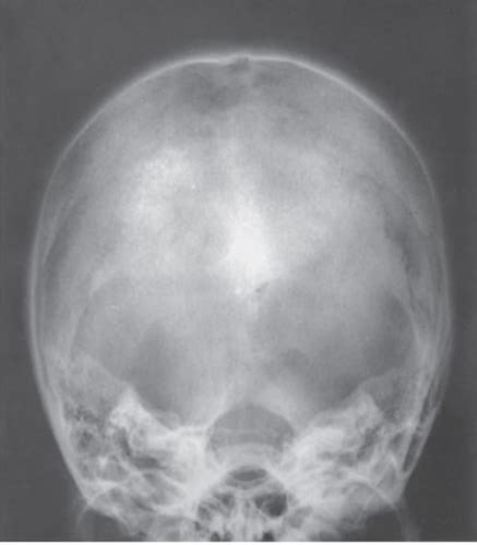 Skull Essential Projections Flashcards Quizlet