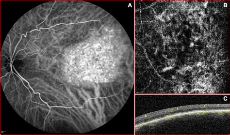 Optical Coherence Tomography Angiography Oct A Of A Circumscribed Download Scientific Diagram