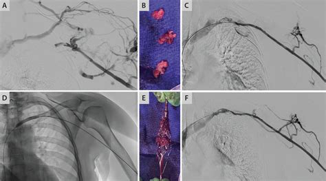 First Reports On The Novel Inthrill Thrombectomy System Endovascular Today