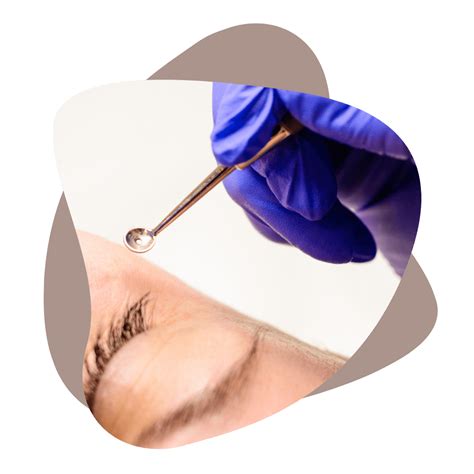 Milia Seeds Removal In Singapore At Vidaskin