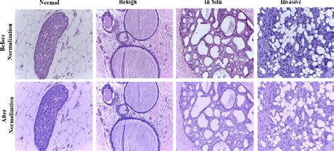 Breast Cancer Histology Image Classification Models Code And Papers Catalyzex