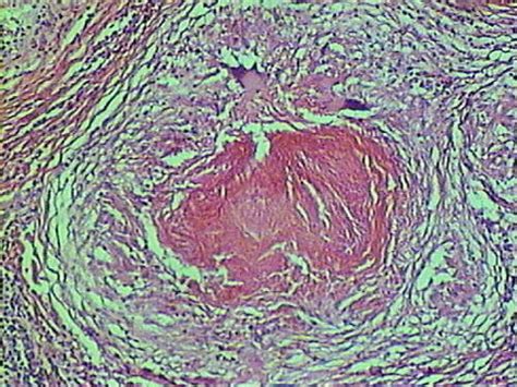 Tuberculous Infection Of Lymph Node The Lymph Node Is Largely Replaced By Multiple Large And