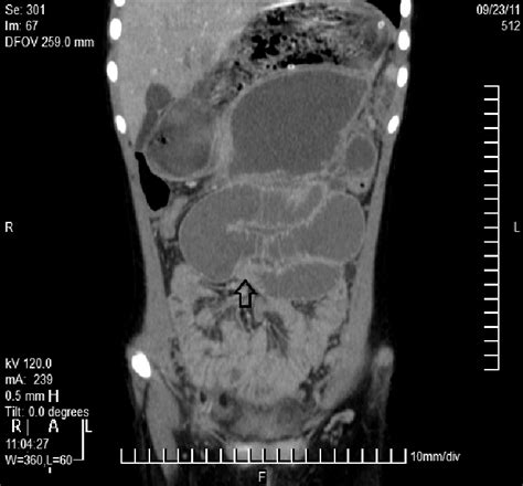 Stricture In Jejunal Loop Cect Demonstrates Dilated Jejunal Loops With