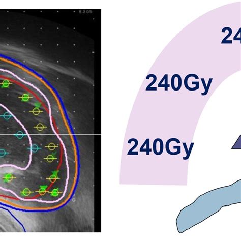 Positioning Of The Peripheral Needles And Creation Of Putative Download Scientific Diagram