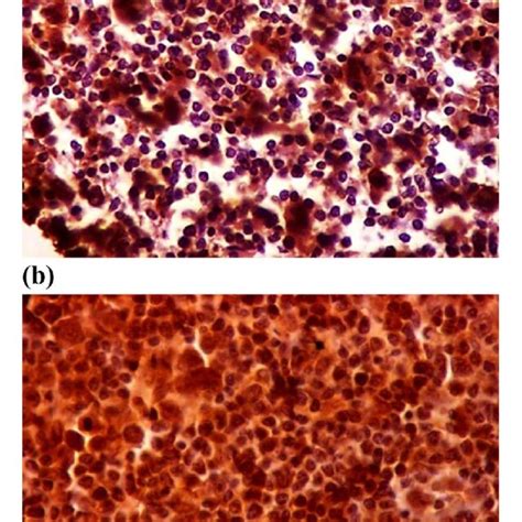Immunohistochemical Expression Of Pd L1 In Dlbcl Photomicrograph A